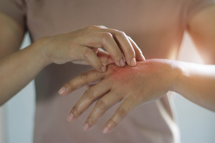 Begini Cara Mengatasi Aquagenic Urticaria atau Alergi Air Hujan